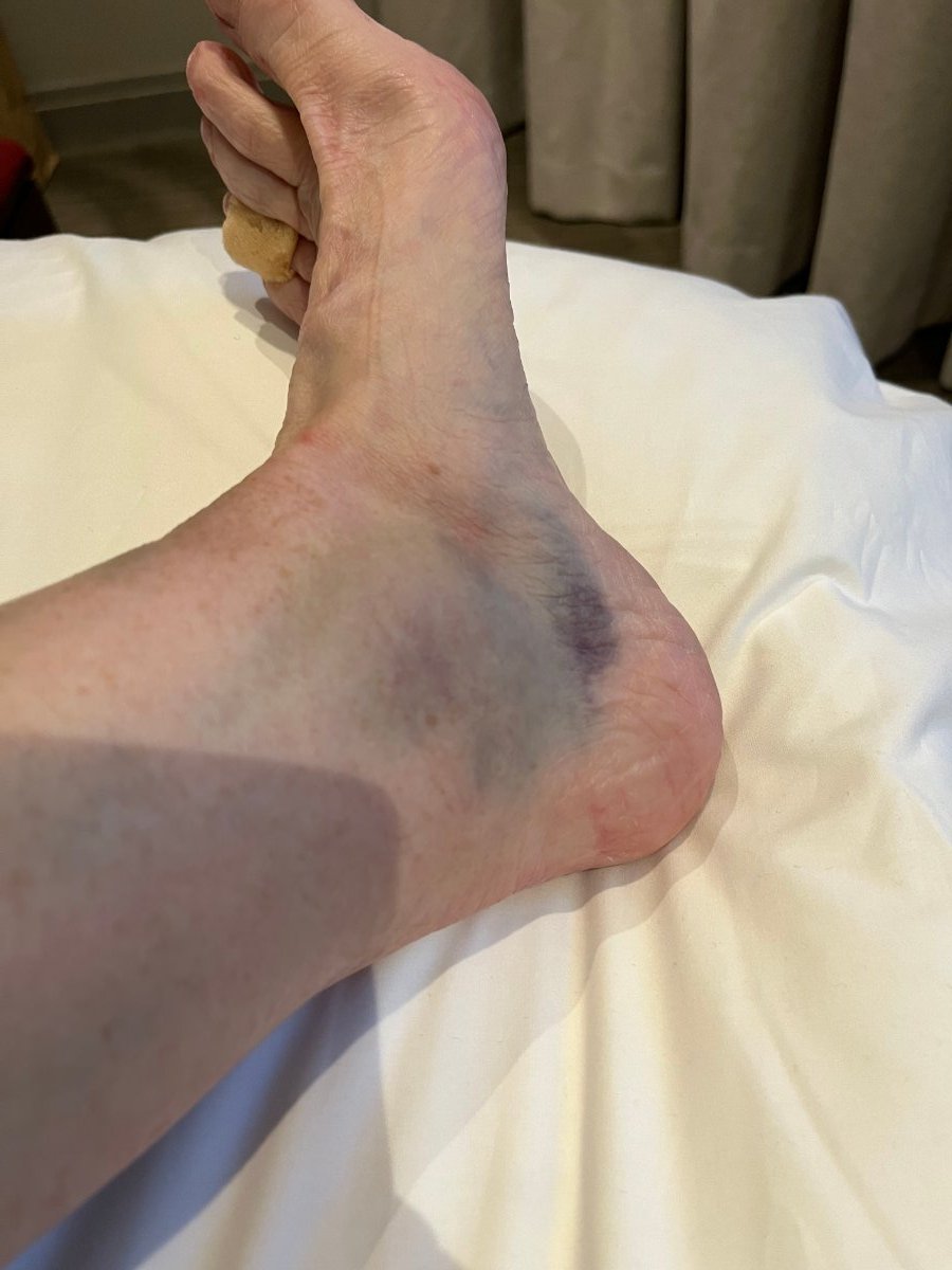 The everyday stupid injury thread - Page 2 - Everyday Chat - Everybump ...